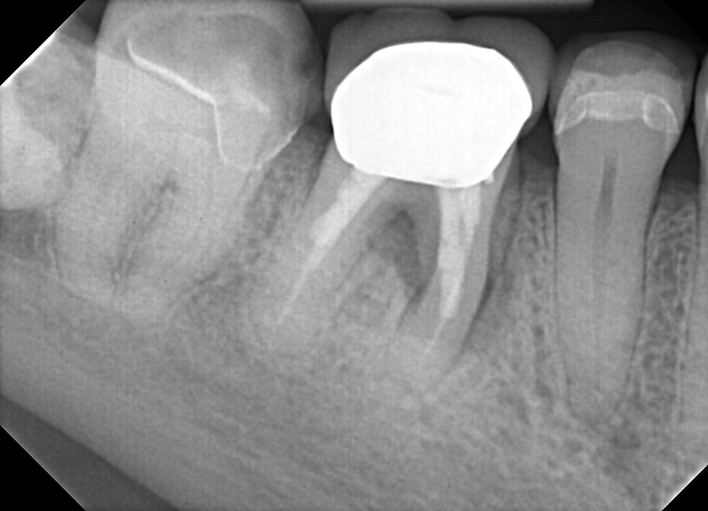 RCT vs Extraction? - Cases and Questions - OsseoNews