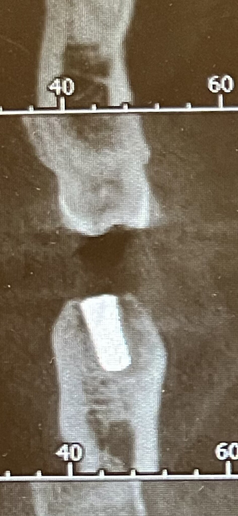 Implant position tilted too lingually. Remove, or restore? - Cases and ...