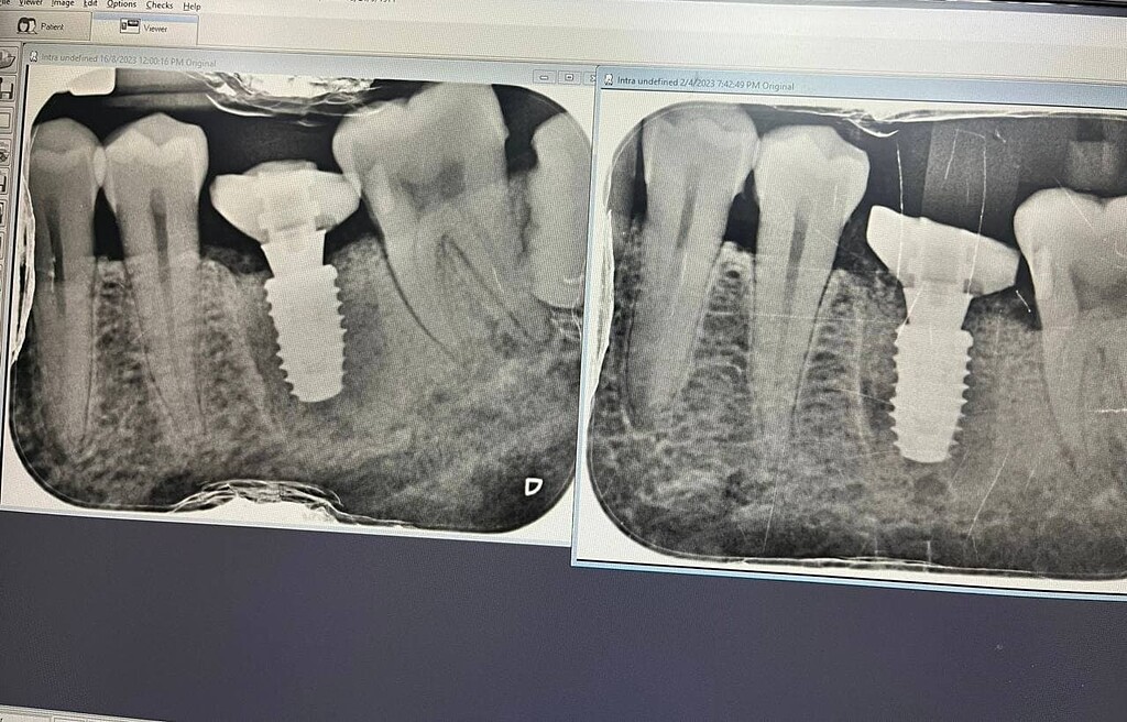 Is this immediate implant failing? - Cases and Questions - OsseoNews