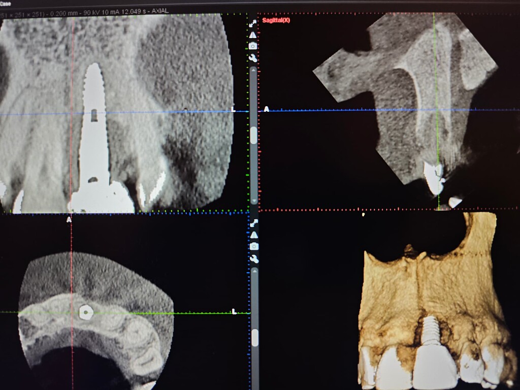 Explant Implant and Vertical GBR? - Cases and Questions - OsseoNews