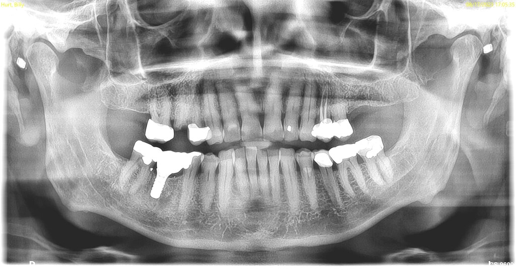 What happened to Tissue Level Implants? - Cases and Questions - OsseoNews What happened to Tissue Level Implants? - Cases and Questions - OsseoNews