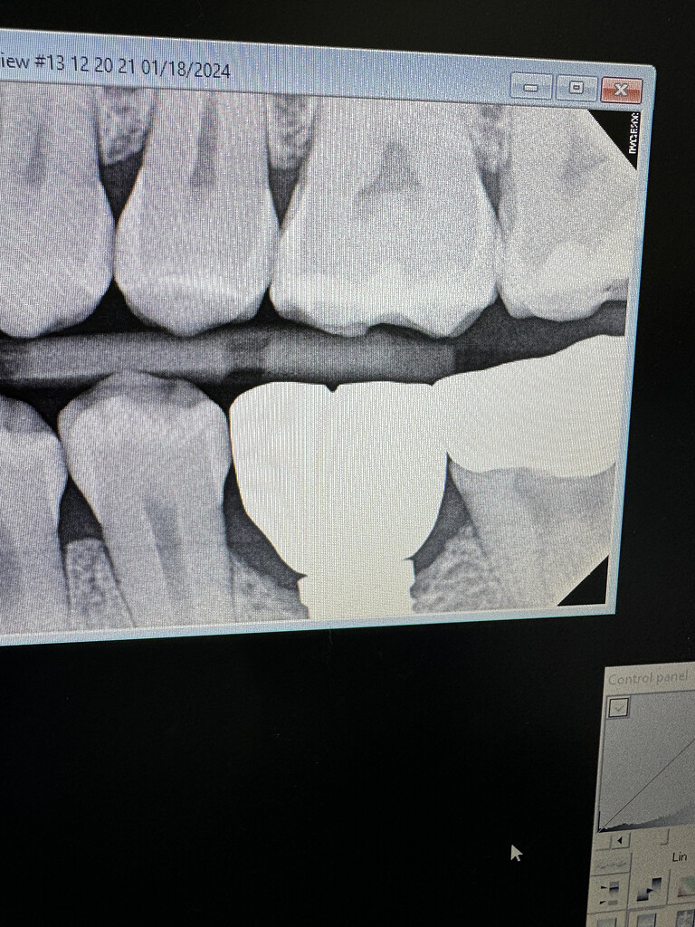 Loose cement retained crown? - Cases and Questions - OsseoNews