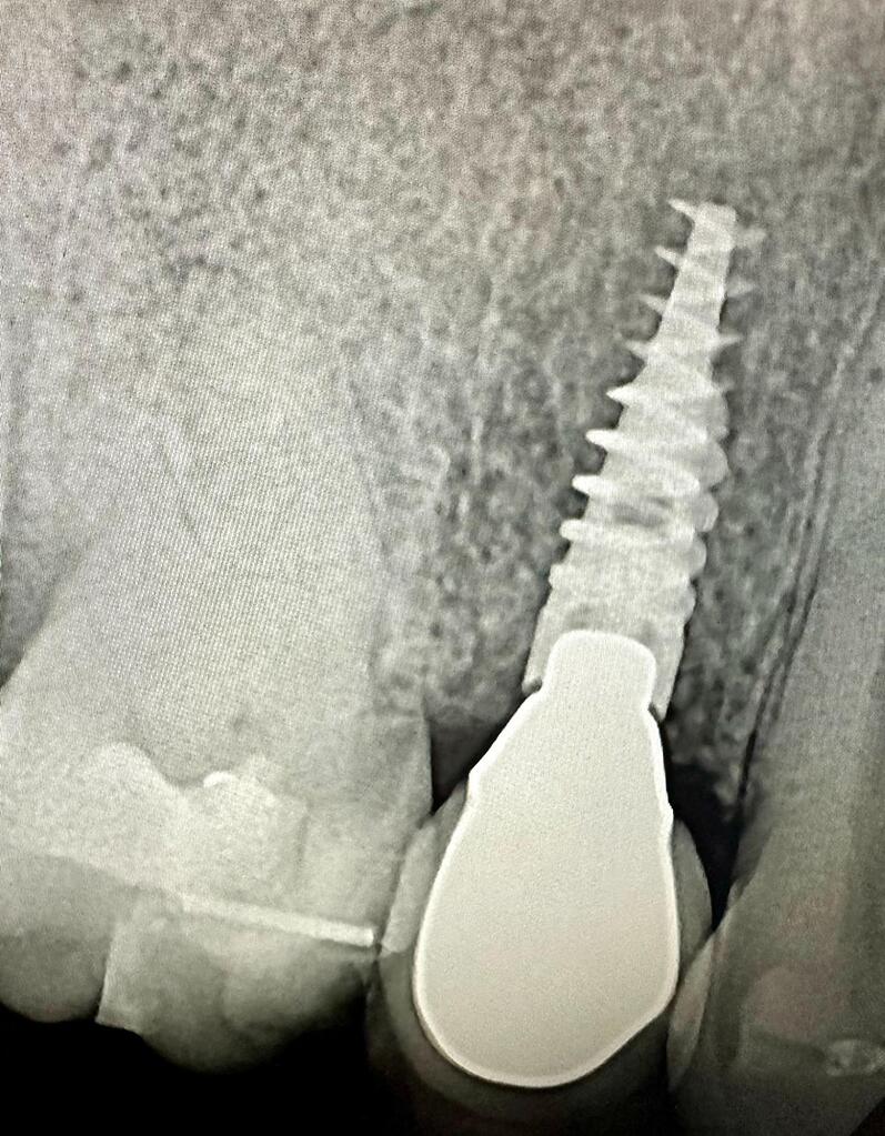 Loose Crown: Causes and Solutions? - Cases and Questions - OsseoNews