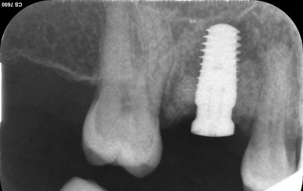 Immediate Implant for Maxillary Molar - Cases and Questions - OsseoNews