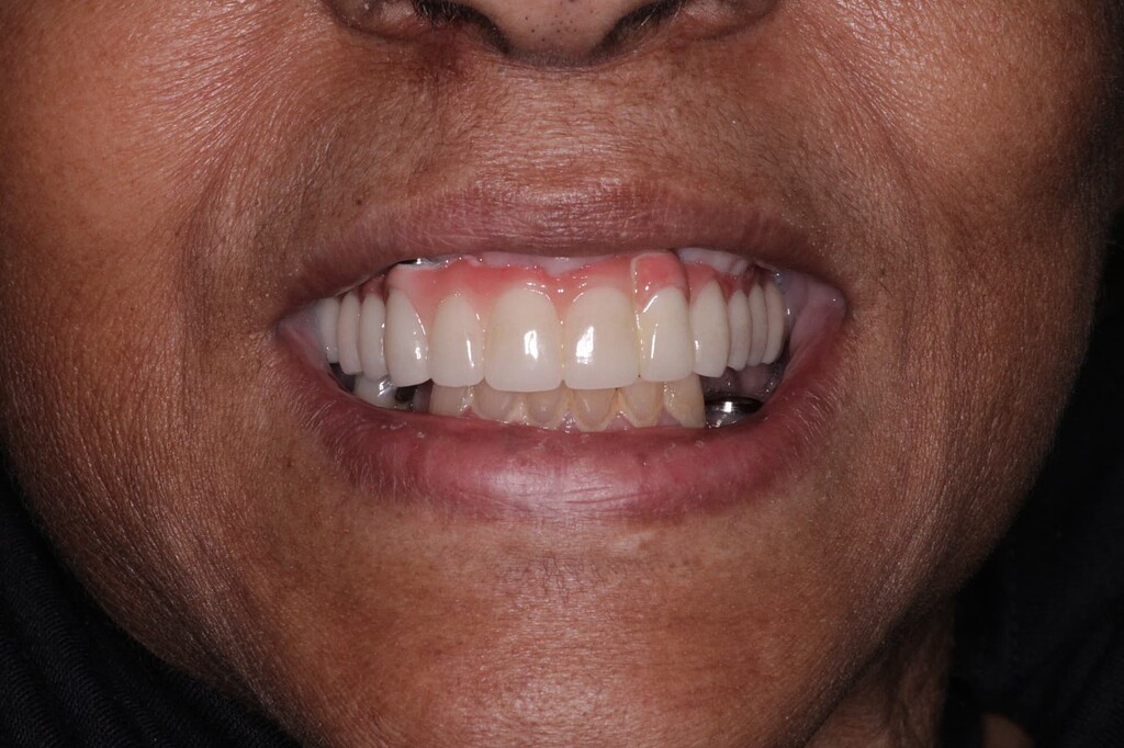 Managing patient satisfaction with full arch fixed restoration? - Cases ...