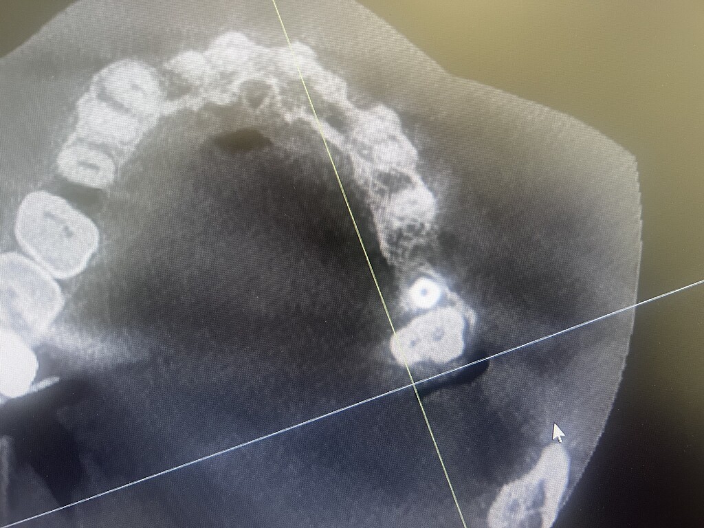 Implant placed too close to tooth - Cases and Questions - OsseoNews