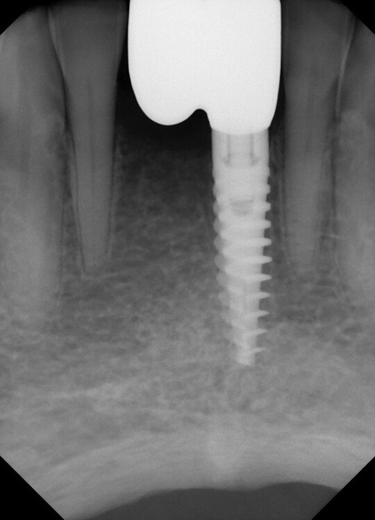 Two Implants or One? - Cases and Questions - OsseoNews