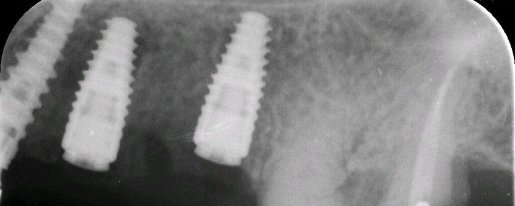Mystery of implant apical radiolucency - Cases and Questions - OsseoNews