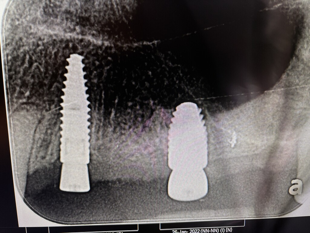 ASC driver not engaging to torque: ever have this issue? - Cases and ...