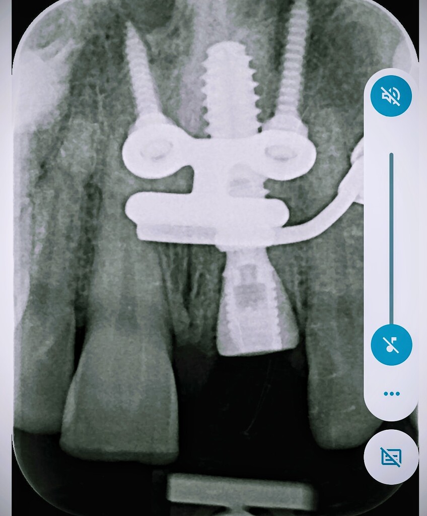 Implant placed too deep, anterior - Cases and Questions - OsseoNews
