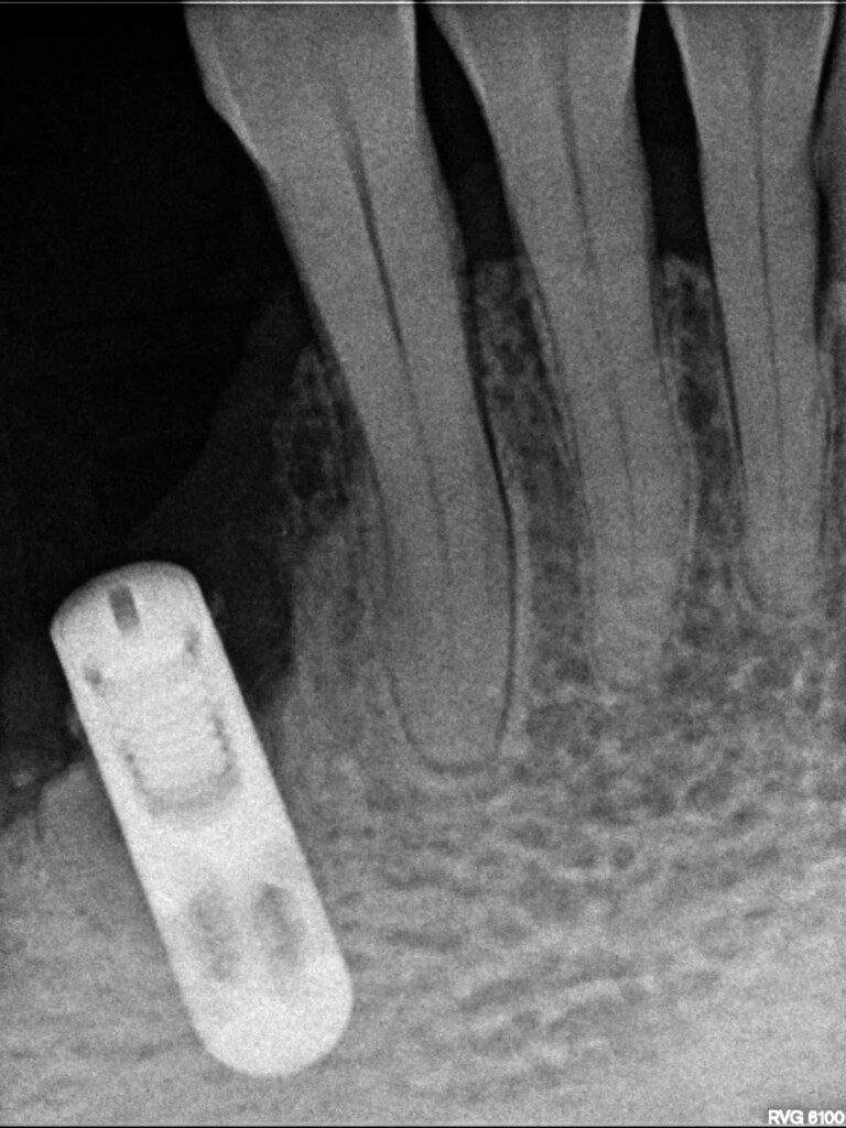 Identify implant - Cases and Questions - OsseoNews