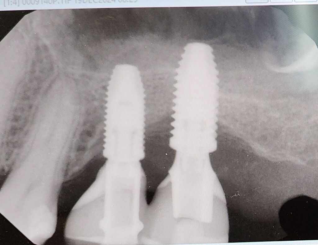 Bone loss around implants - Cases and Questions - OsseoNews