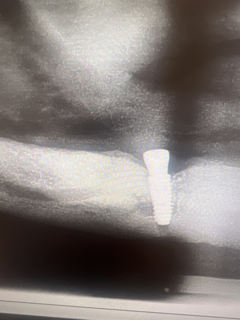 Perforating the inferior border - Cases and Questions - OsseoNews