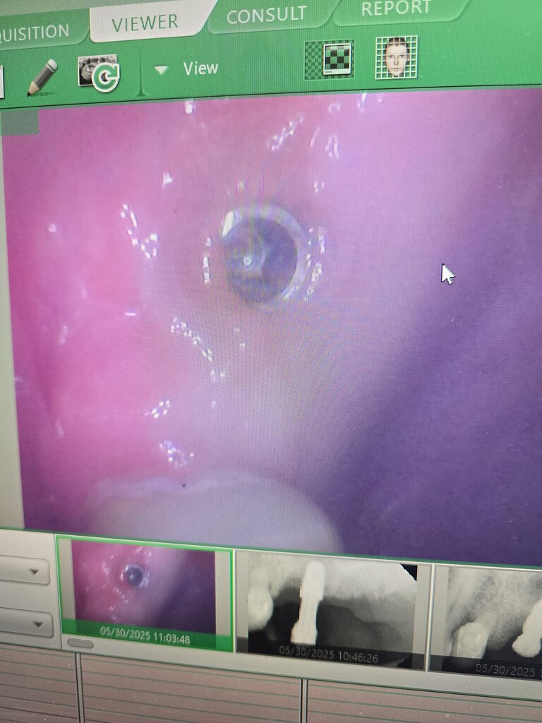 Peri-mucositis? How to manage - Cases and Questions - OsseoNews