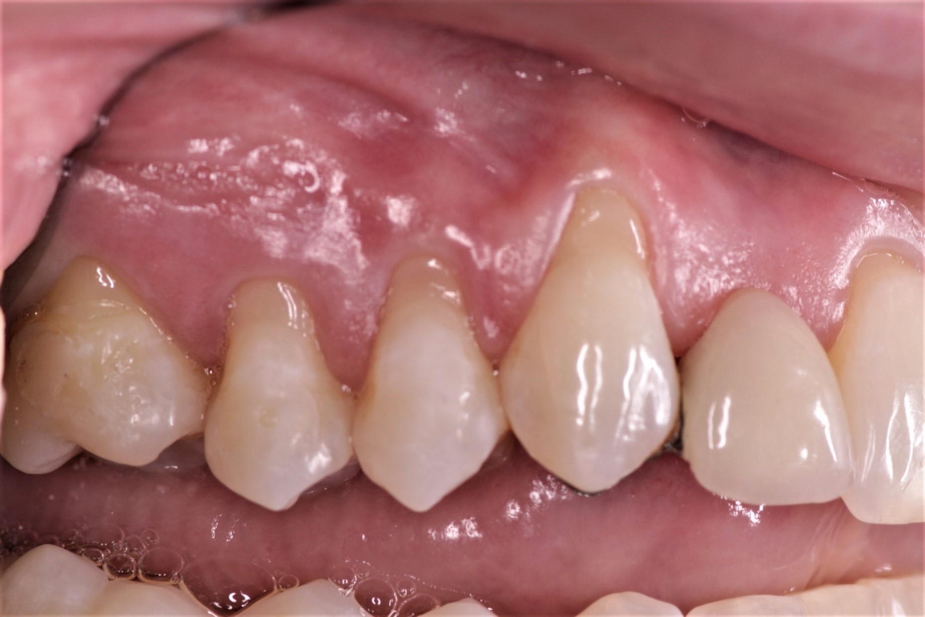 Soft Tissue Defects Cases And Questions OsseoNews Soft Tissue Defects Cases And Questions OsseoNews